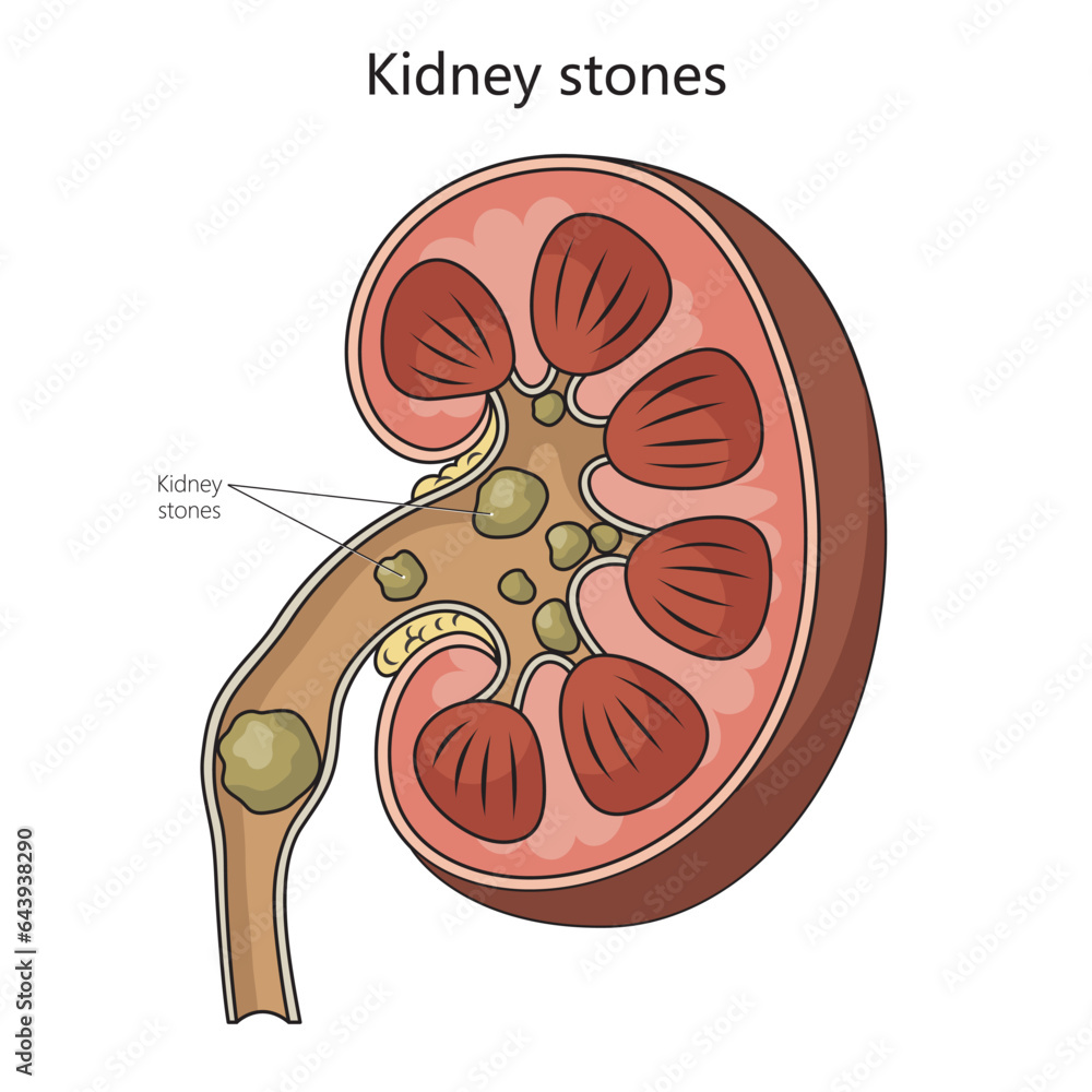 Kidney stone disease diagram schematic vector illustration. Medical ...