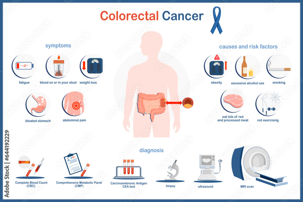 Vector infographic illustration of colon cancer. Medical illustration ...