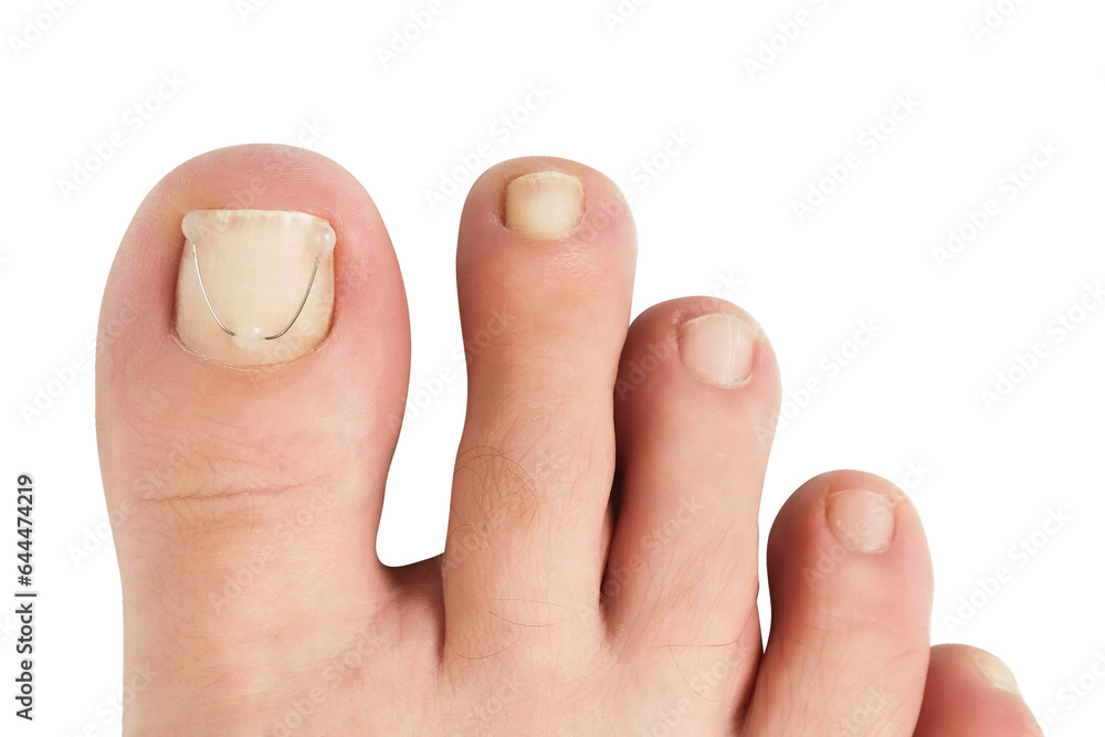 Titanium thread on the nail of the big toe. Ingrown toenail treatment ...