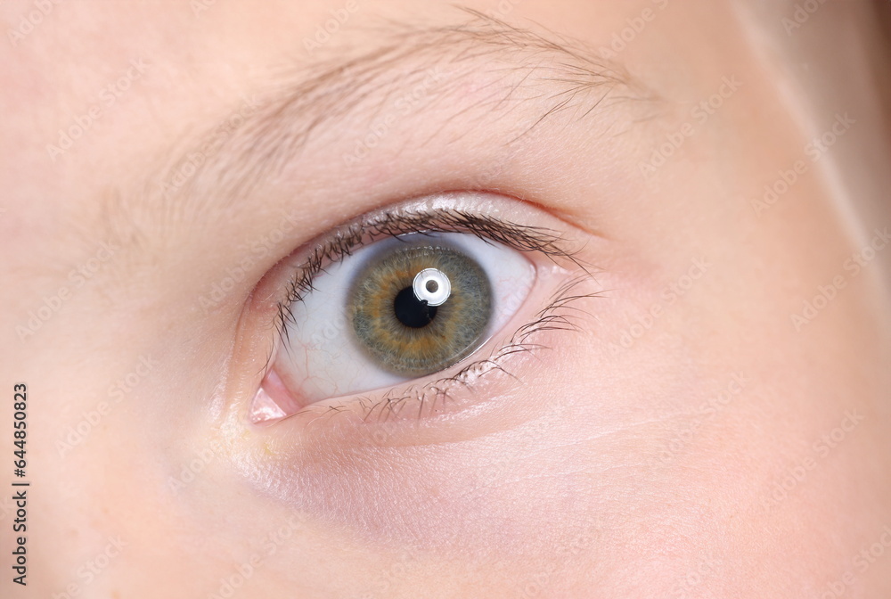 Wide open child's eye with an eyebrow and moles on skin. Visual ...
