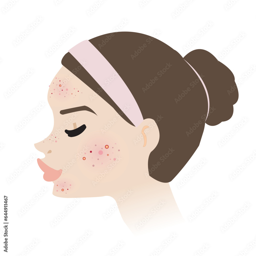 Woman face with acne skin side view vector isolated on white background ...