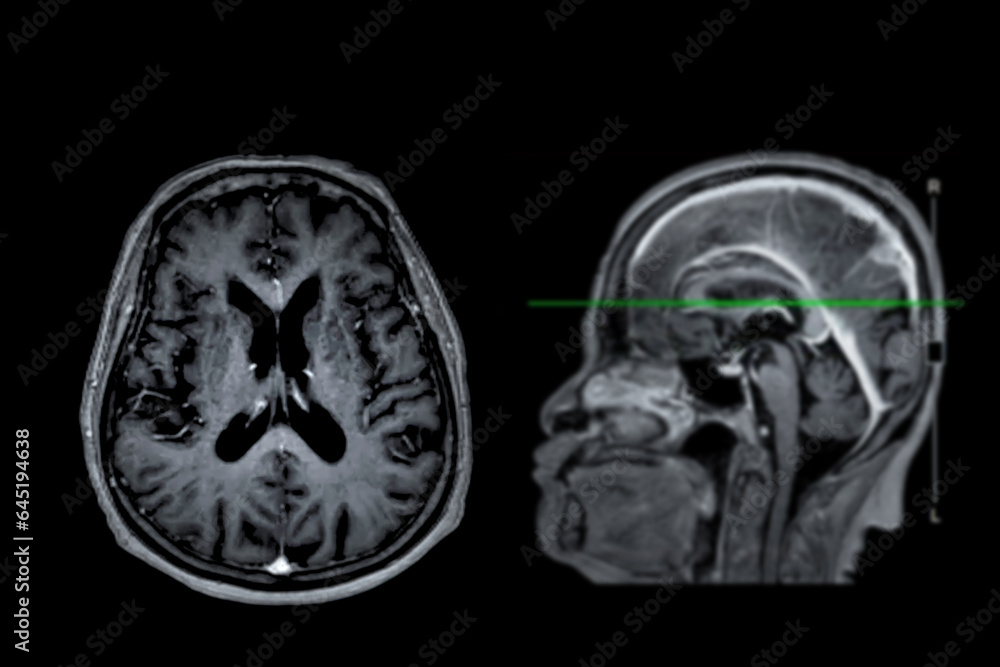 MRI brain scan Axial and sagittal view with reference line for detect ...