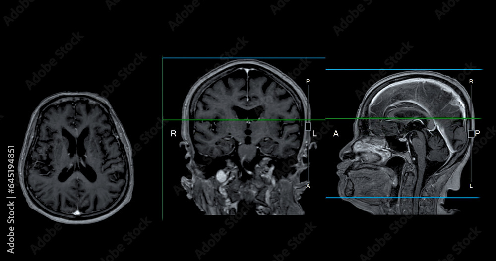 MRI brain scan Axial , Coronal and sagittal view with referance line for detect Brain diseases ...