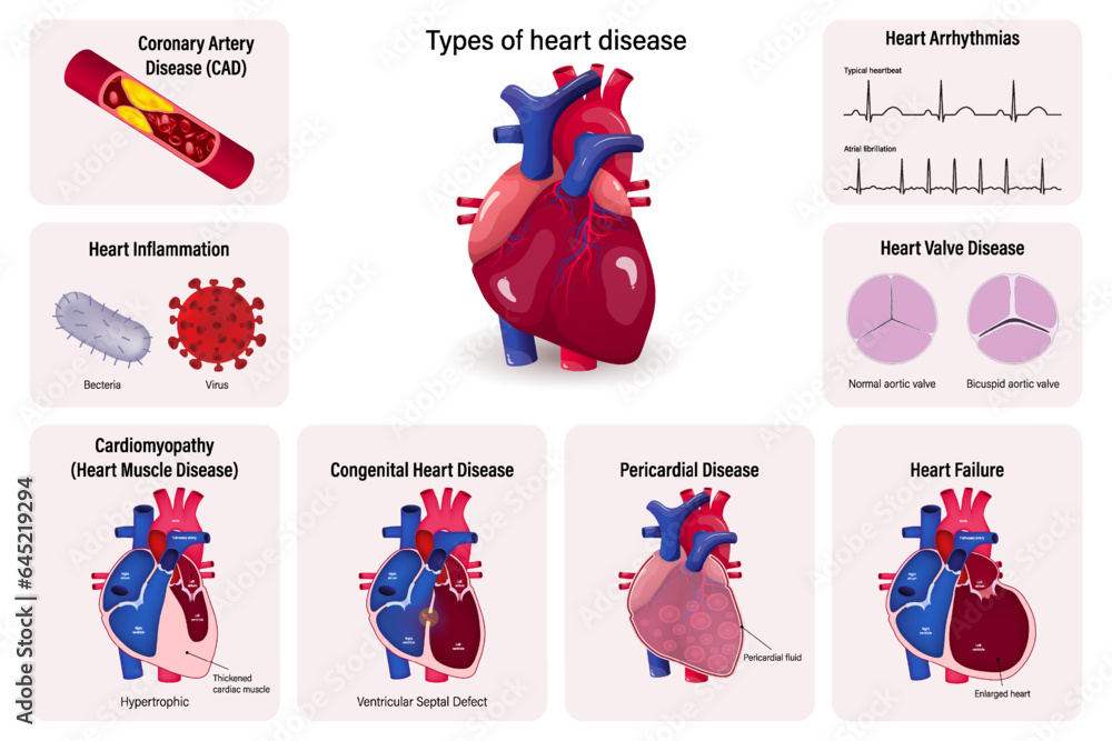 Types of heart disease vector. Coronary Artery Disease (CAD), Heart Inflammation, Cardiomyopathy ...