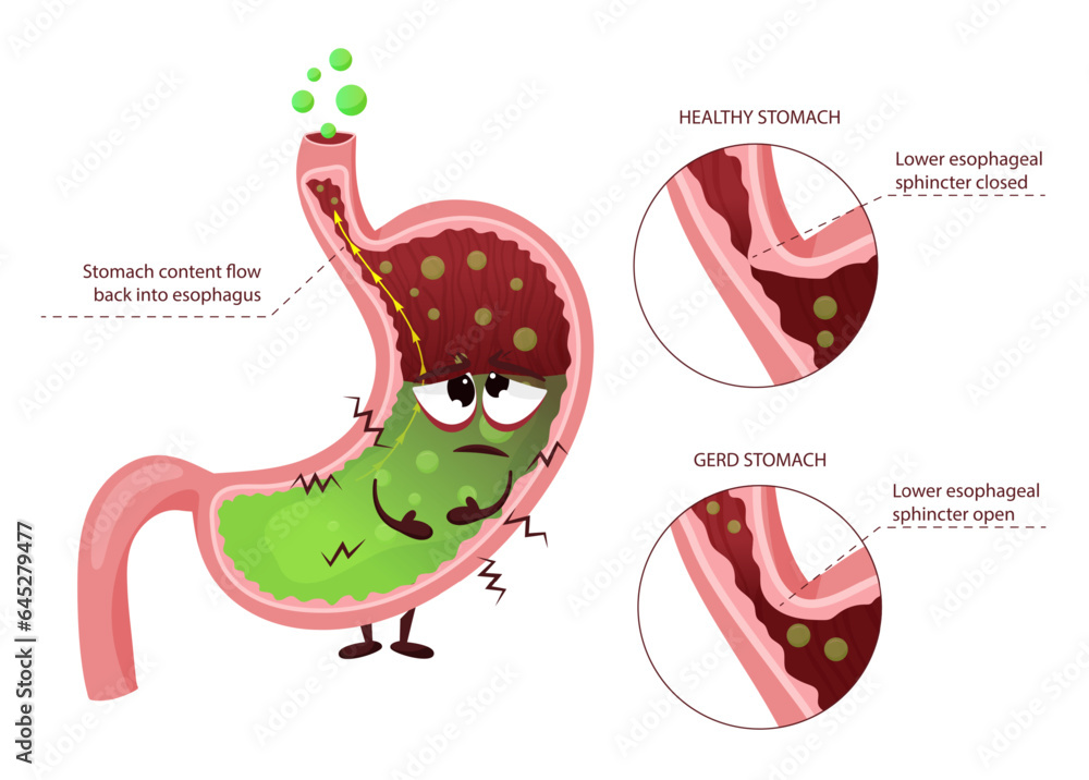 Gastroesophageal reflux disease GERD diagram with sad stomach cartoon ...