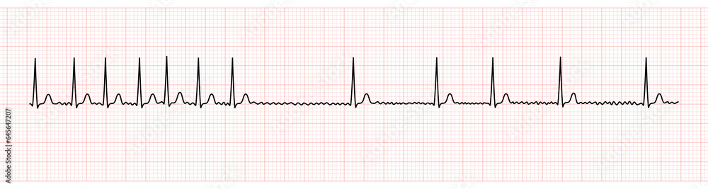 EKG Monitor Showing Atrial Fibrillation With Rapid Ventricular Response ...