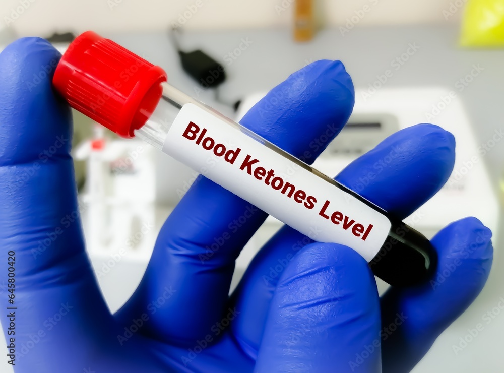 Blood sample tube for ketone test, diagnosis for diabetic ketoacidosis ...