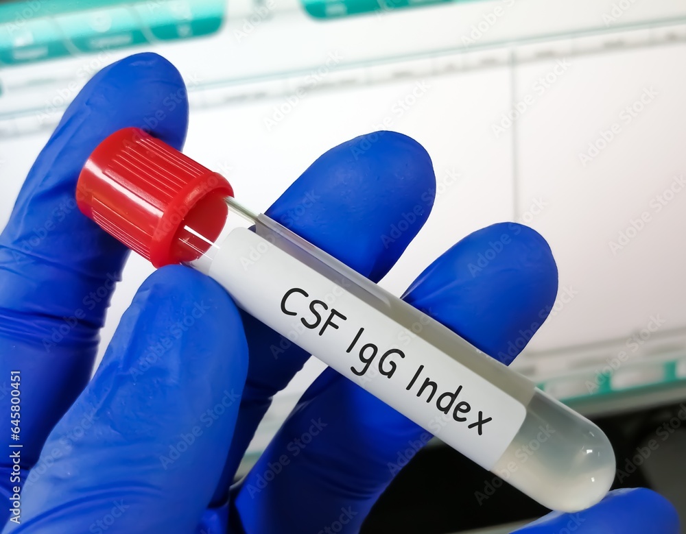 CSF IgG index measures the levels of IgG in cerebrospinal fluid. High levels of IgG may means an ...
