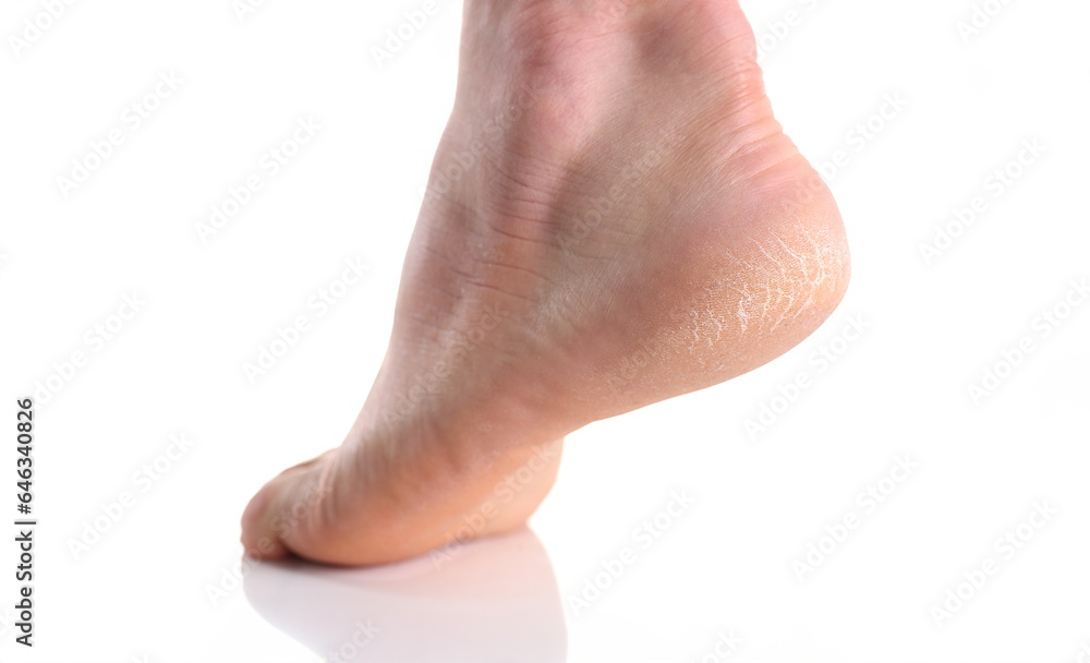 The heel of foot with bad skin is covered with cracks. The concept ...