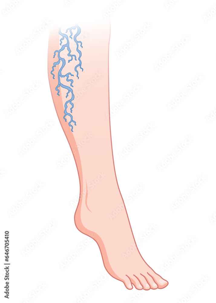 Varicose veins. Blue blood vessel visible through the skin, abnormally ...