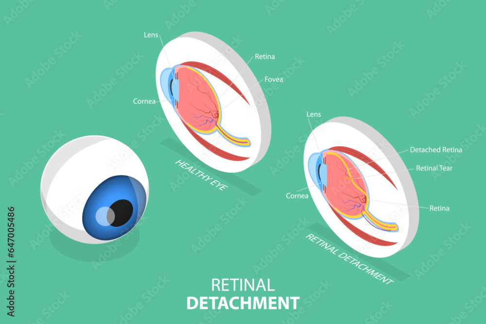 3D Isometric Flat Vector Conceptual Illustration of Retinal Detachment ...