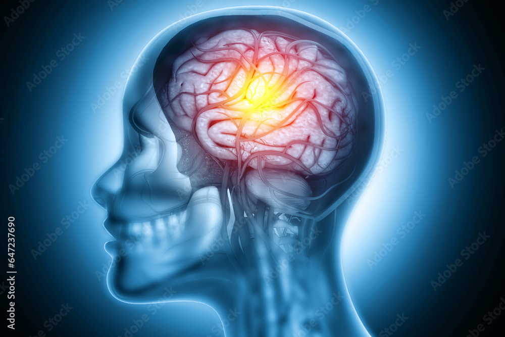 Human brain injury,damage,hemorrhage. 3d illustration Stock ...