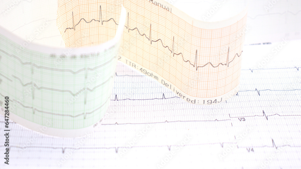 heart rhythm ekg note on paper doctors use to analyze heart disease ... heart rhythm ekg note on paper doctors use to analyze heart disease ...
