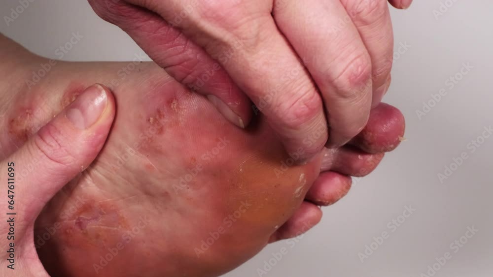 Woman showing her damaged toes. Huge wound on female skin after several ...