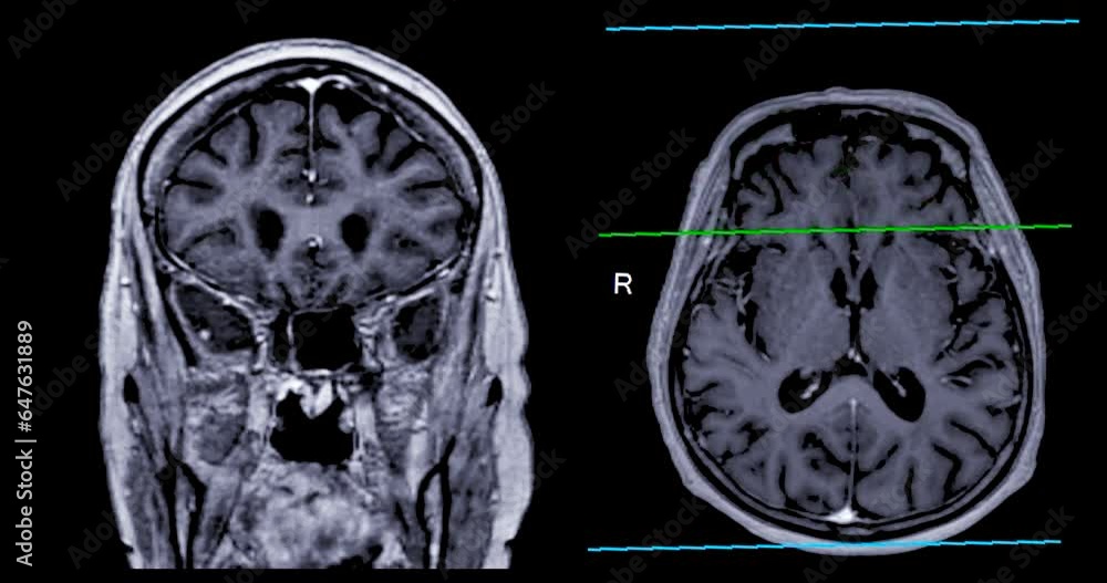 MRI Brain with reference line can help doctors look for conditions such ...