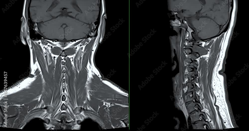 MRI of C-spine or magnetic resonance image of cervical spine Coronal ...