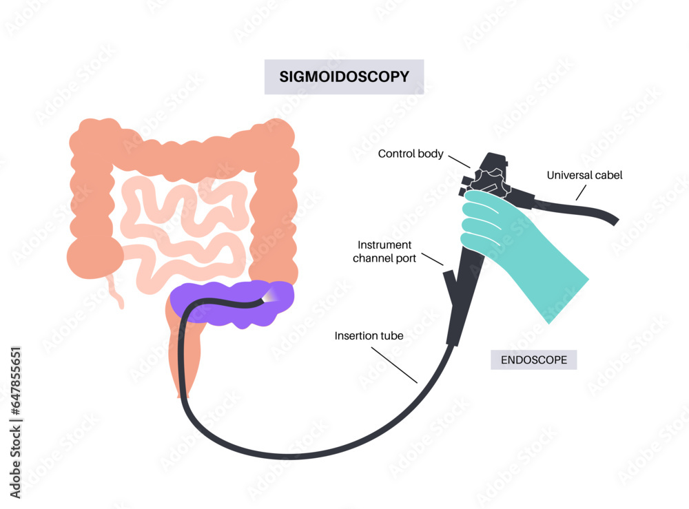 Sigmoidoscopy medical procedure Stock Vector | Adobe Stock