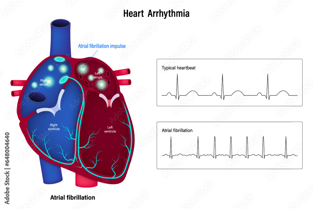 Heart arrhythmia vector. Cardiac Arrhythmia. Atrial fibrillation. An ...