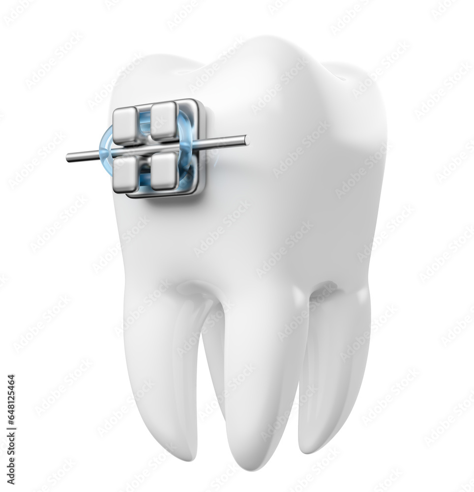 Realistic teeth with dental braces in on transparent background in 3d ...