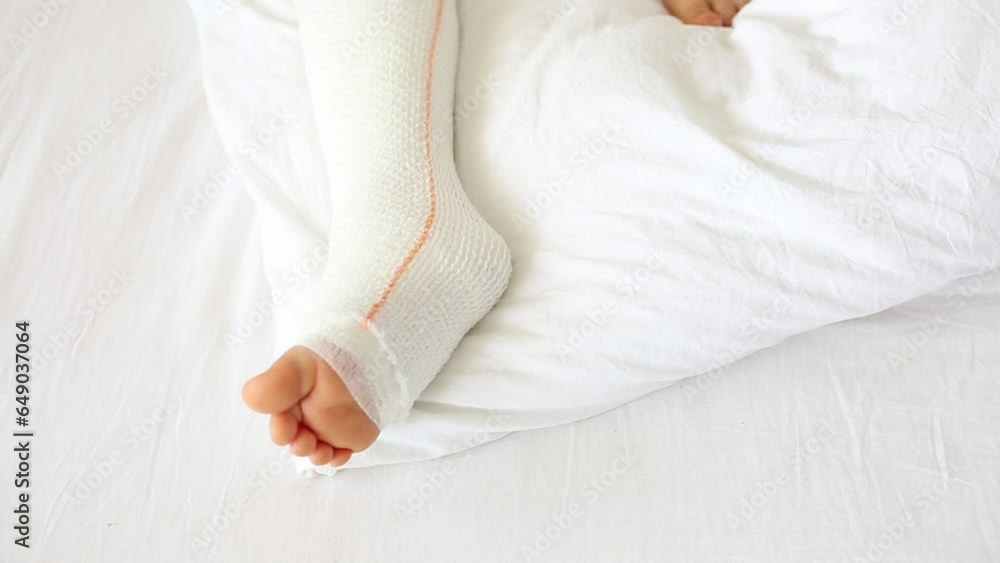 Children's broken leg in orthopedic cast on a white bed in the . Broken ...