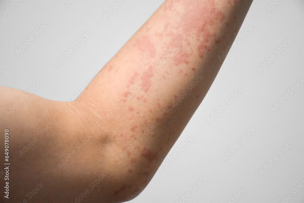 Close up red rash on asian man arm , skin background, arm severely ...