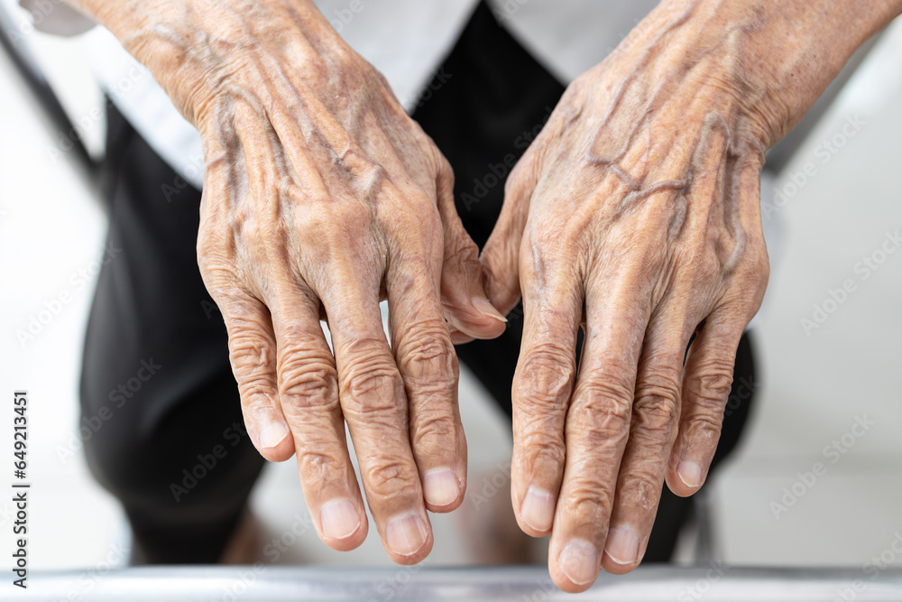 Old elderly woman showing wrinkled hands and bulging vein on the back ...