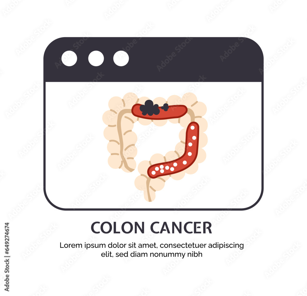 Type of cancer colon concept. Disease of iternal organ. Illness of ...