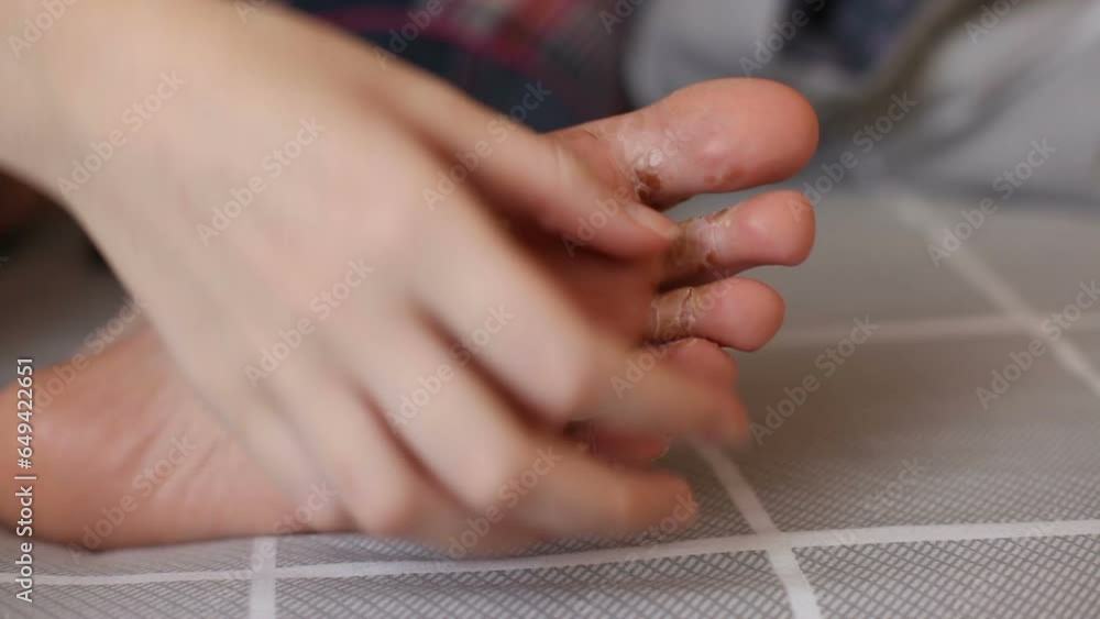 Feet of a young girl on bed, affected by coxsackie virus. Ulcers and ...