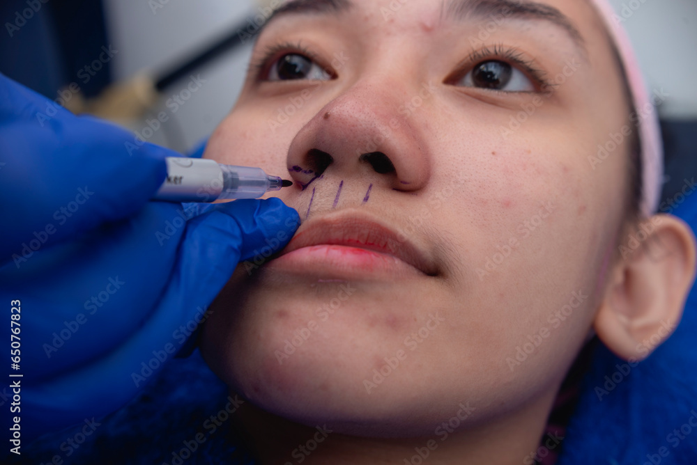 A cosmetic surgeon drawing lines on the alar of a pateint's nose before ...