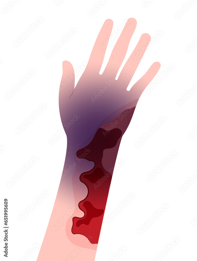 Hand skin infection of the Necrotizing fasciitis cause limb leg pain ...