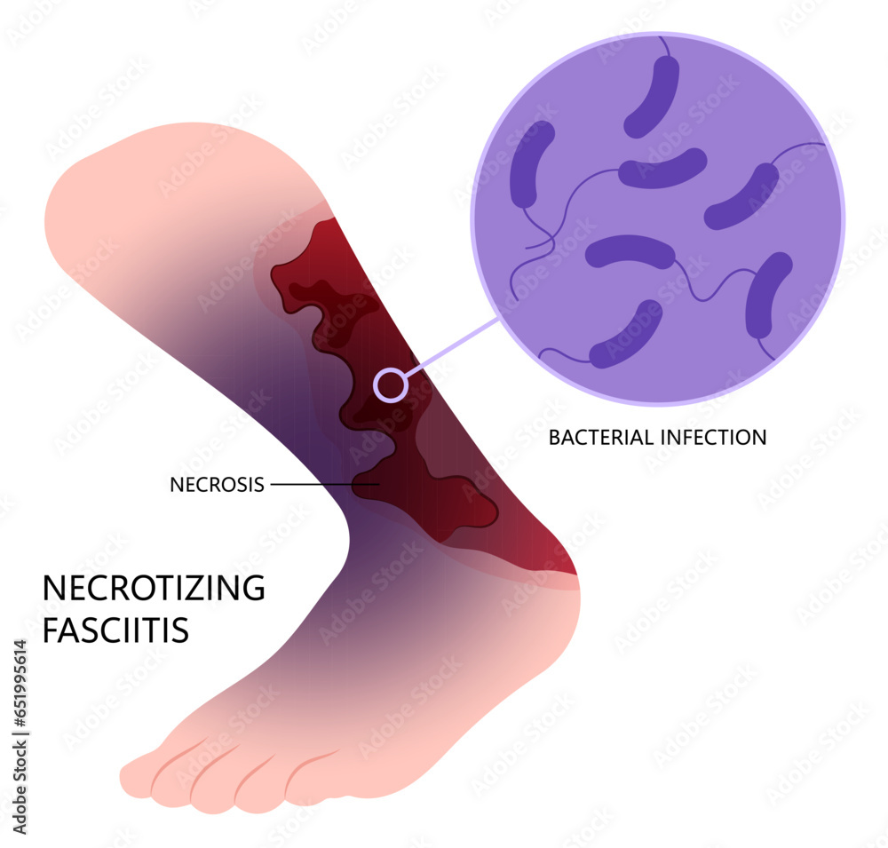 Bacteria infection on the skin cancer with Necrotizing fasciitis of leg ...
