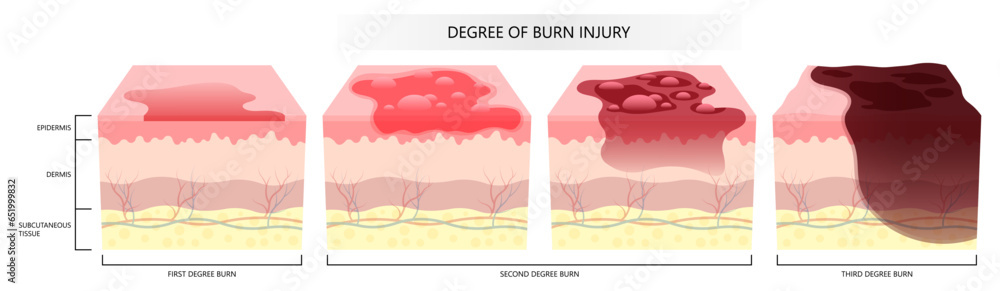 Póster Stages of skin burn injury and scalds of epidermis and dermis layer cause by fla – Cuadro ...