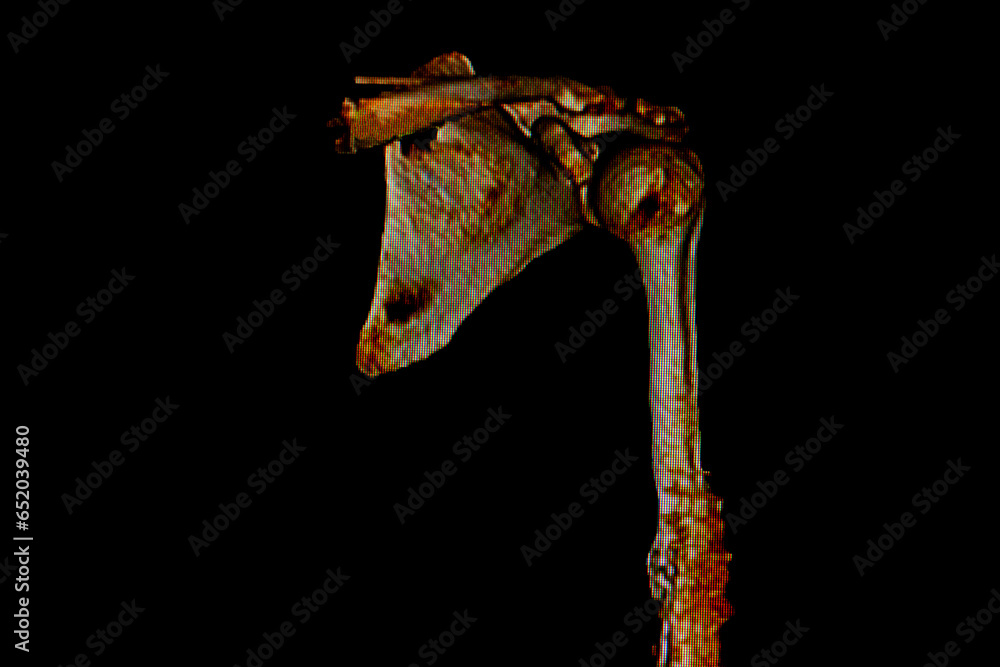 Cat Scan of Femur fracture frontal view. Medical themes Stock Photo ...