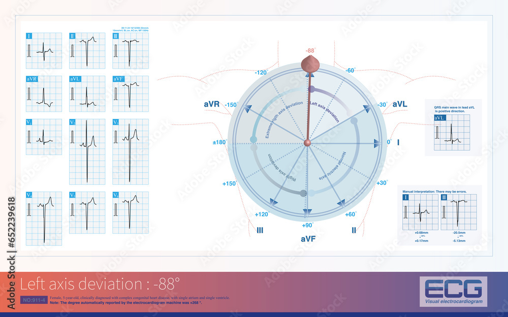 When the electrical axis of the electrocardiogram is severely left ...
