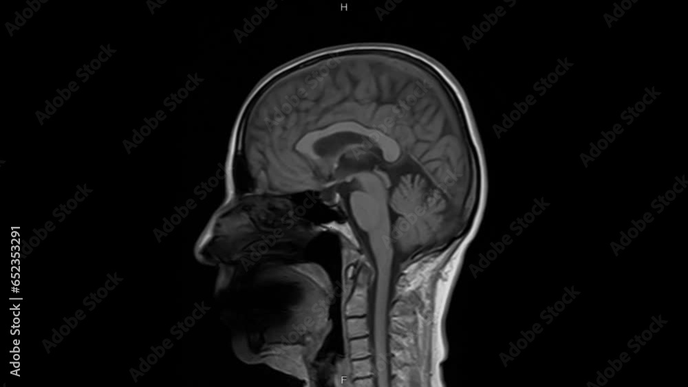 Magnetic resonance imaging of the brain. MRI of the brain. Medical ...