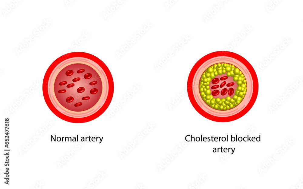 Atherosclerosis, normal artery versus narrowed artery blocked with ...