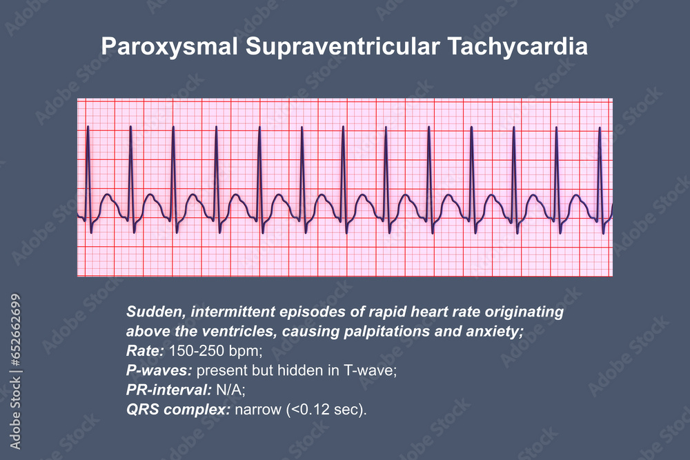 ECG in supraventricular tachycardia, 3D illustration Stock Illustration ...