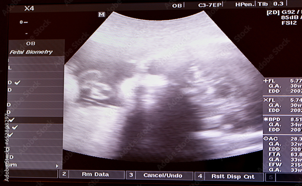 Ultrasonography on the uterus of a pregnant woman showing a healthy ...