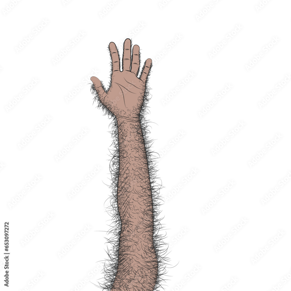 Hirsutism, Arm with a lot of hair, high levels of male hormones. Stock ...