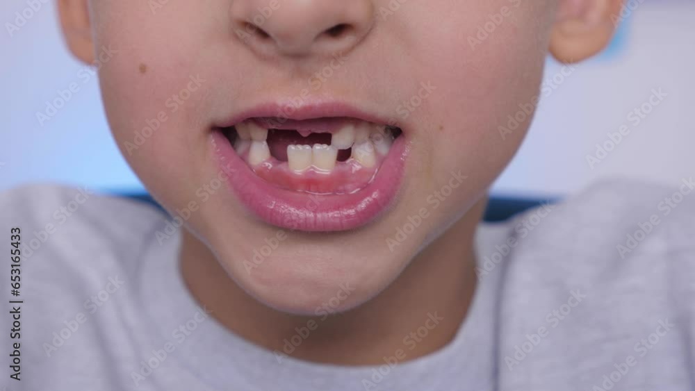 Close-up mouth child has lost one milk teeth. Replacement of permanent ...