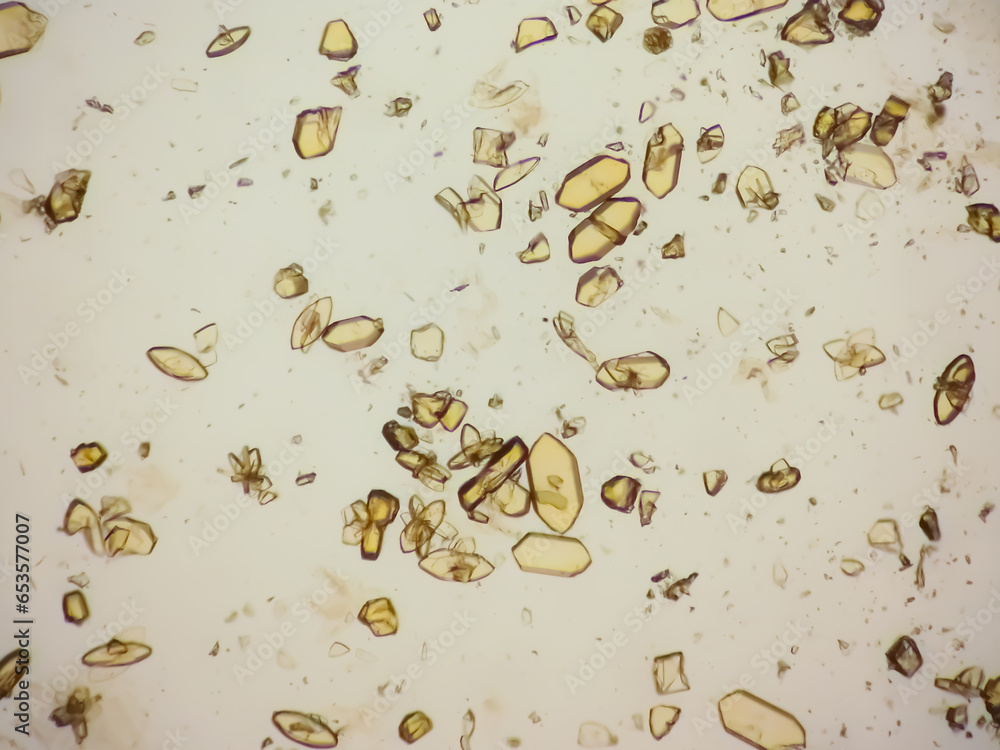 Photomicrograph of Uric acid crystal in urine sediment Stock Photo ...