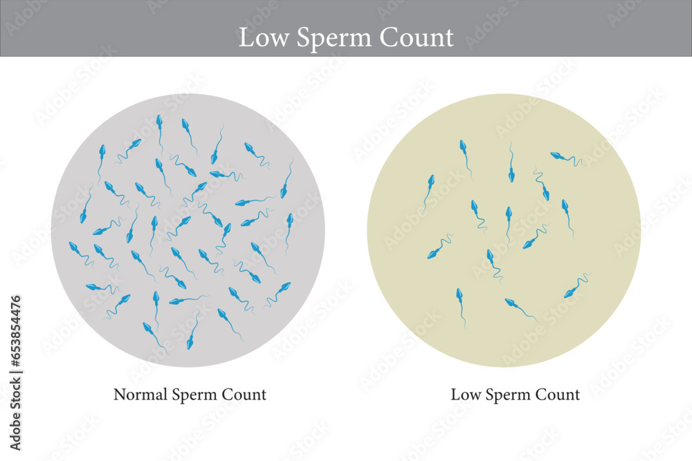 normal and low sperm count illustration. Male infertility oligospermia ...