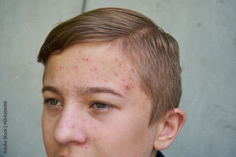 pimples on the boy's forehead,boy with acne, facial rashes, skin ...