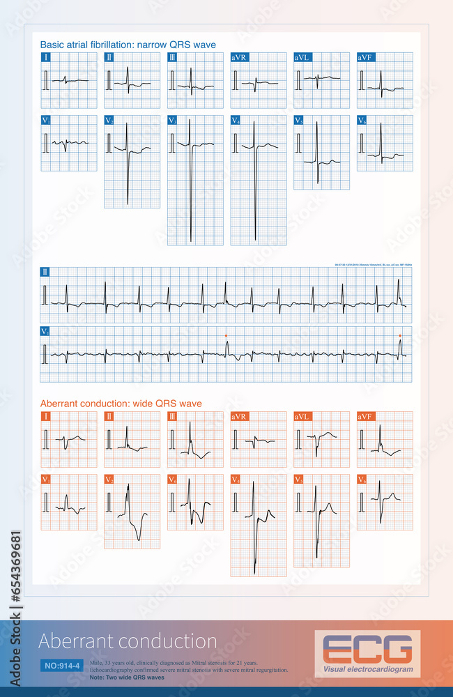 Photo & Art Print When atrial fibrillation occurs, if the initial ...