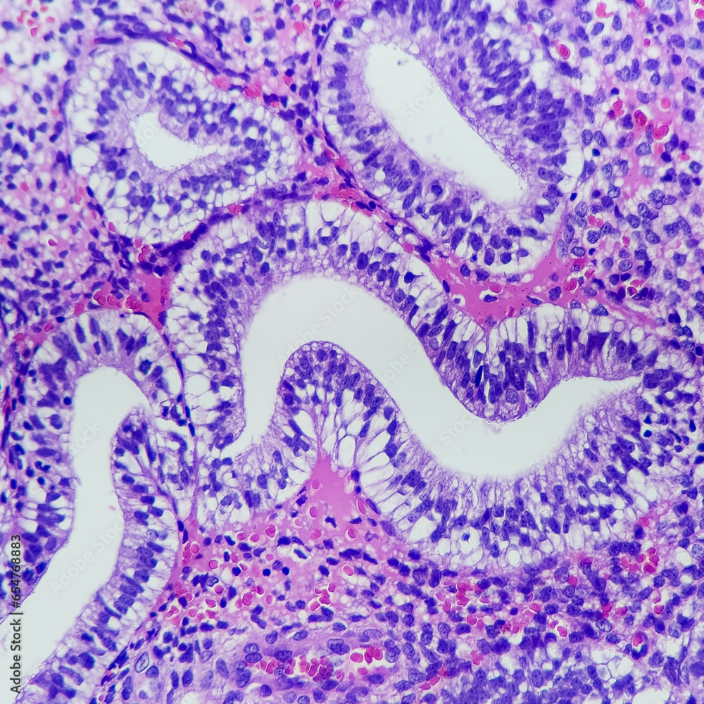 Camera photo of secretory endometrium, showing tortuous glands with ...