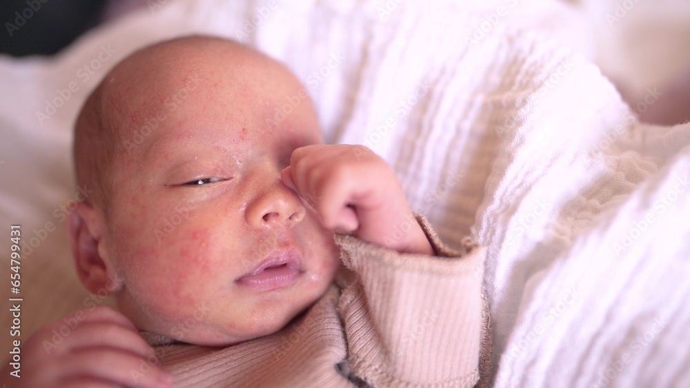 sick baby newborn with acne. hospital a medicine care for babies ...