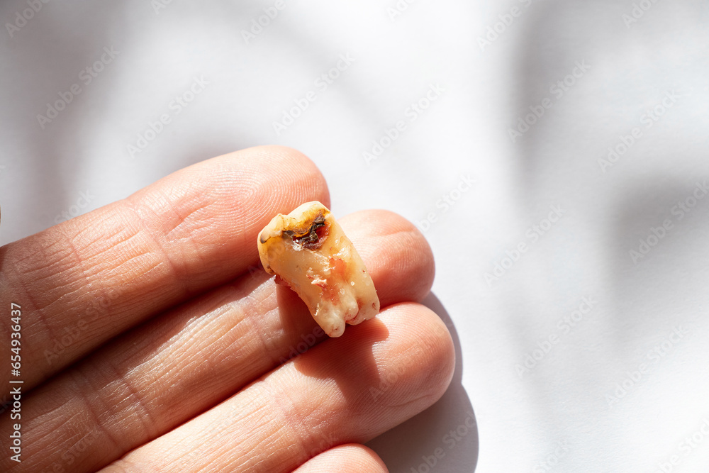 A girl in her hand holds an extracted tooth with a black hole in the ...