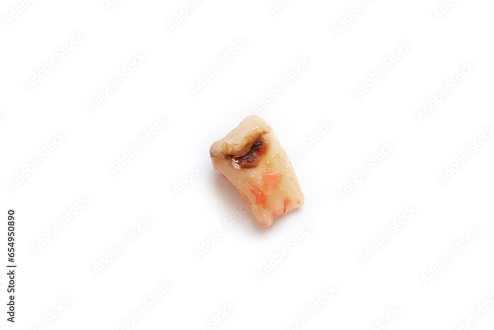 An extracted tooth destroyed with caries and a hole in the middle lies ...