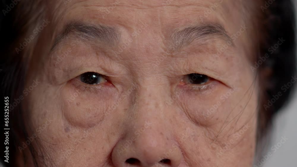 Close up of the senile cataract during eye examination. A white cloudy ...