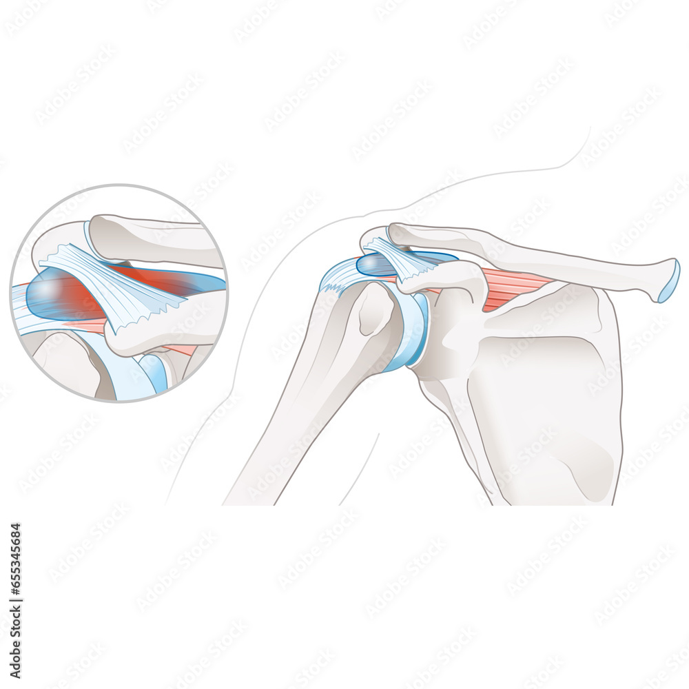 Subacromial bursitis of the shoulder. Medically Illustration. Labeled ...